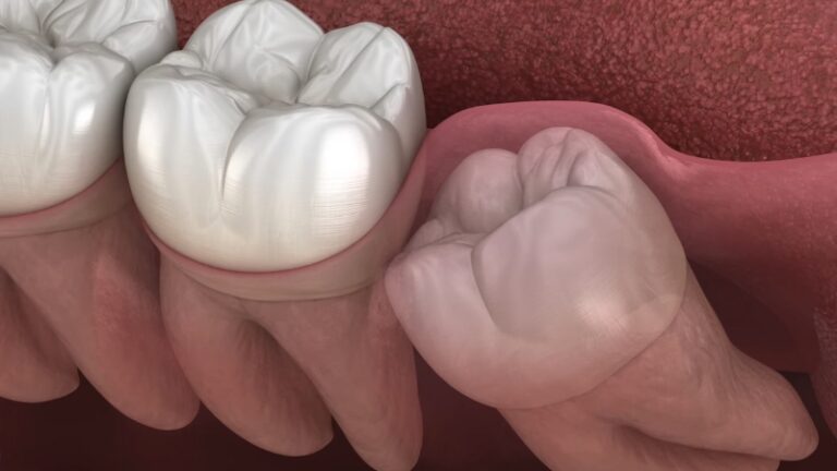 How Many Wisdom Teeth Do People Have? Why It’s Different for Everyone