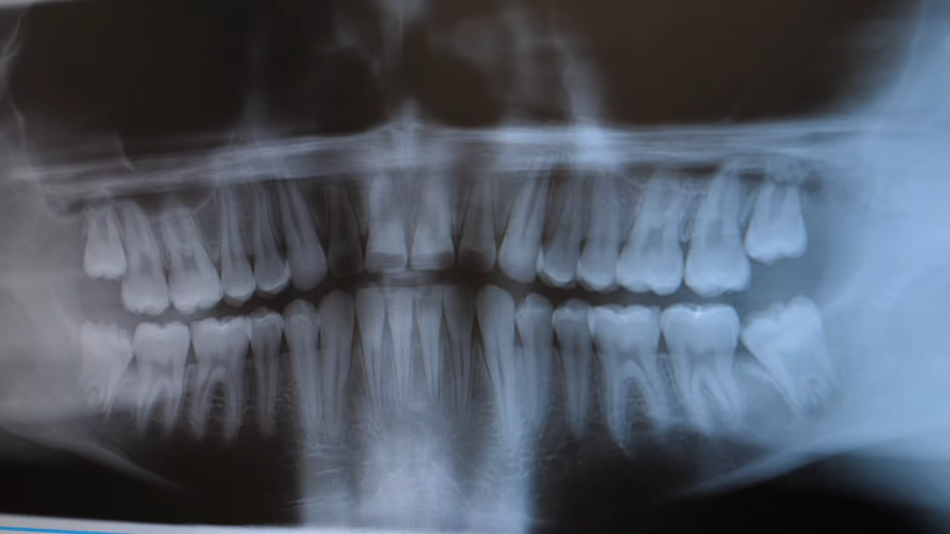 Is It Possible to Decline Dental X-Rays? What Patients Should Know ...